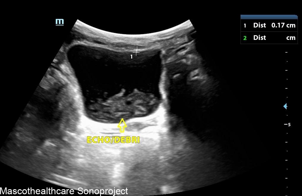 Urinary Bladder Sludge – Mascot Healthcare Sonoproject