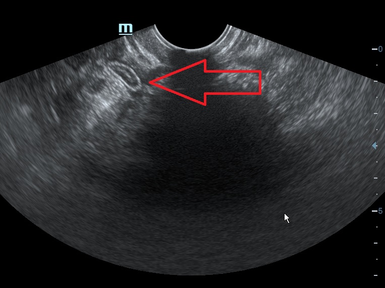 Normal Appendix Visualized Through an Endovaginal Scan - Mascot ...