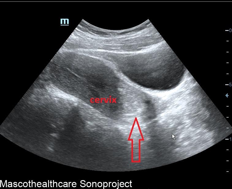 Cervical Polyp - Mascot Healthcare Sonoproject