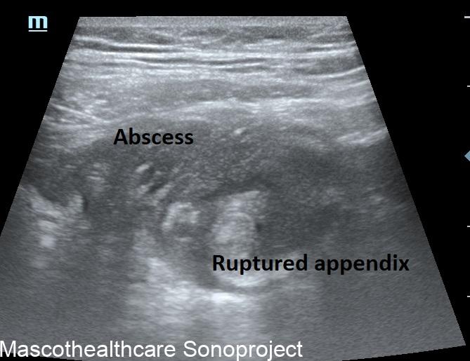 Appendiceal abscess - Mascot Healthcare Sonoproject