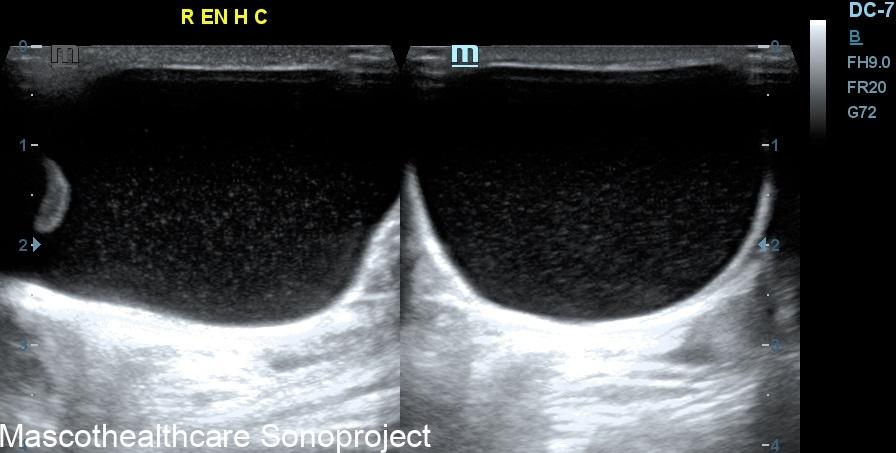 Encysted Hydrocele of the Cord – Mascot Healthcare Sonoproject