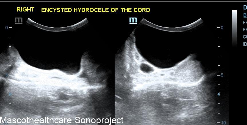 Encysted Hydrocele of the Cord - Mascot Healthcare Sonoproject