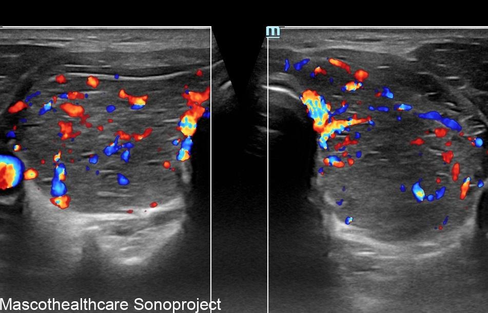 Sonographic features of Graves’ Disease – Mascot Healthcare Sonoproject