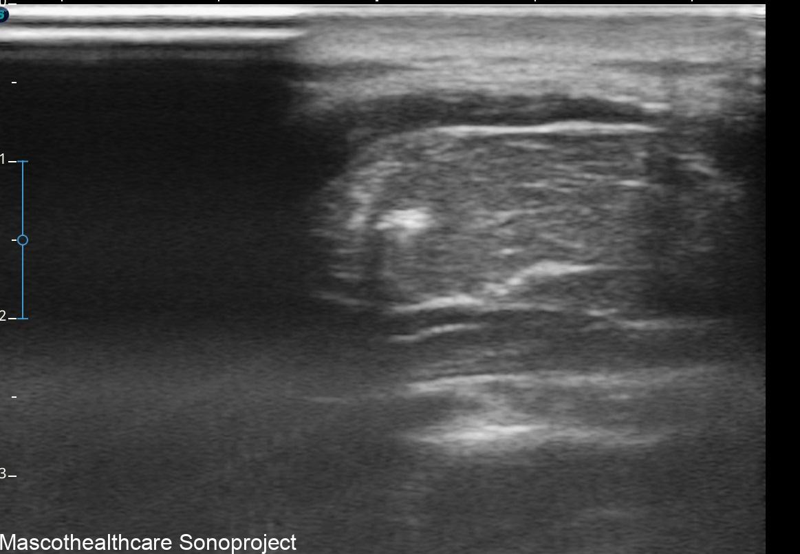 Intramuscular Lipoma – Mascot Healthcare Sonoproject