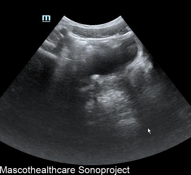 Moderate Hydronephrosis Ultrasound U POCUS Protocol To Rule Out Kidney