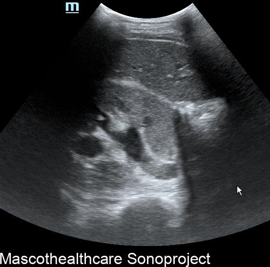 Mild Hydronephrosis – Mascot Healthcare Sonoproject