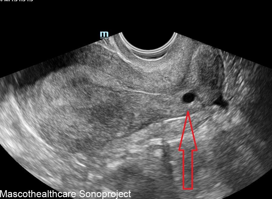 Nabothian Cysts – Mascot Healthcare Sonoproject