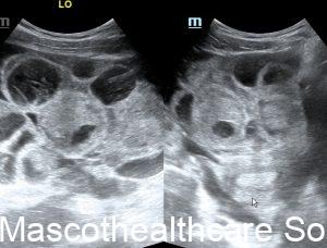 Ultrasound Features of Ovarian Hyperstimulation Syndrome - Mascot ...