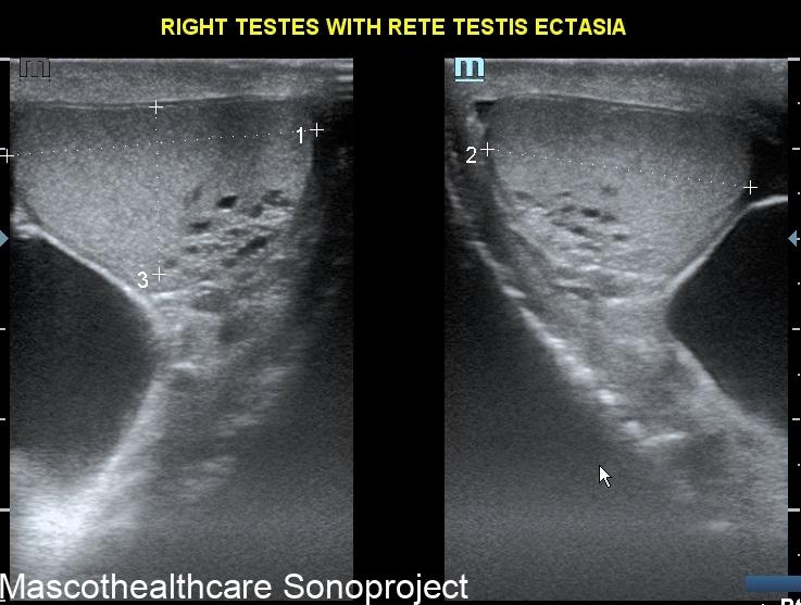 Ectasia of the Rete Testis – Mascot Healthcare Sonoproject