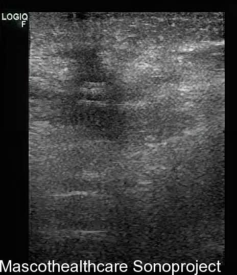 Sonographic Features of Post-surgical Stitch Sinus - Mascot Healthcare ...