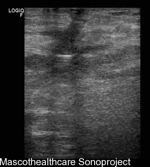Sonographic Features of Post-surgical Stitch Sinus – Mascot Healthcare ...