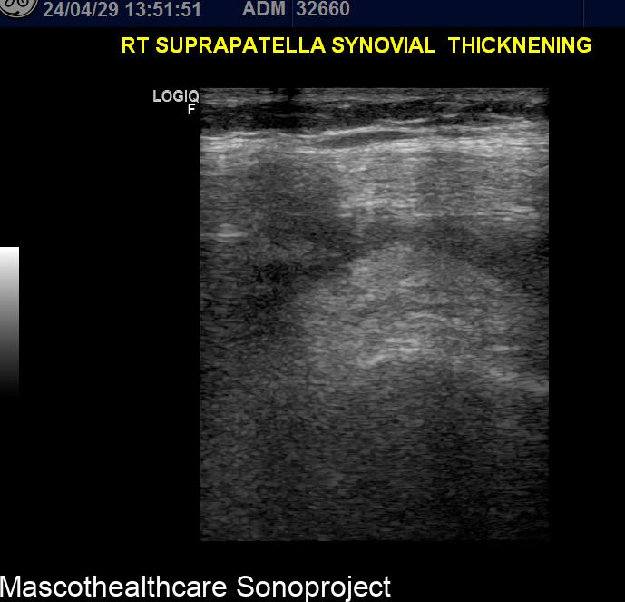 Ultrasound Findings in Pigmented Villonodular Synovitis (PVNS) – Mascot ...